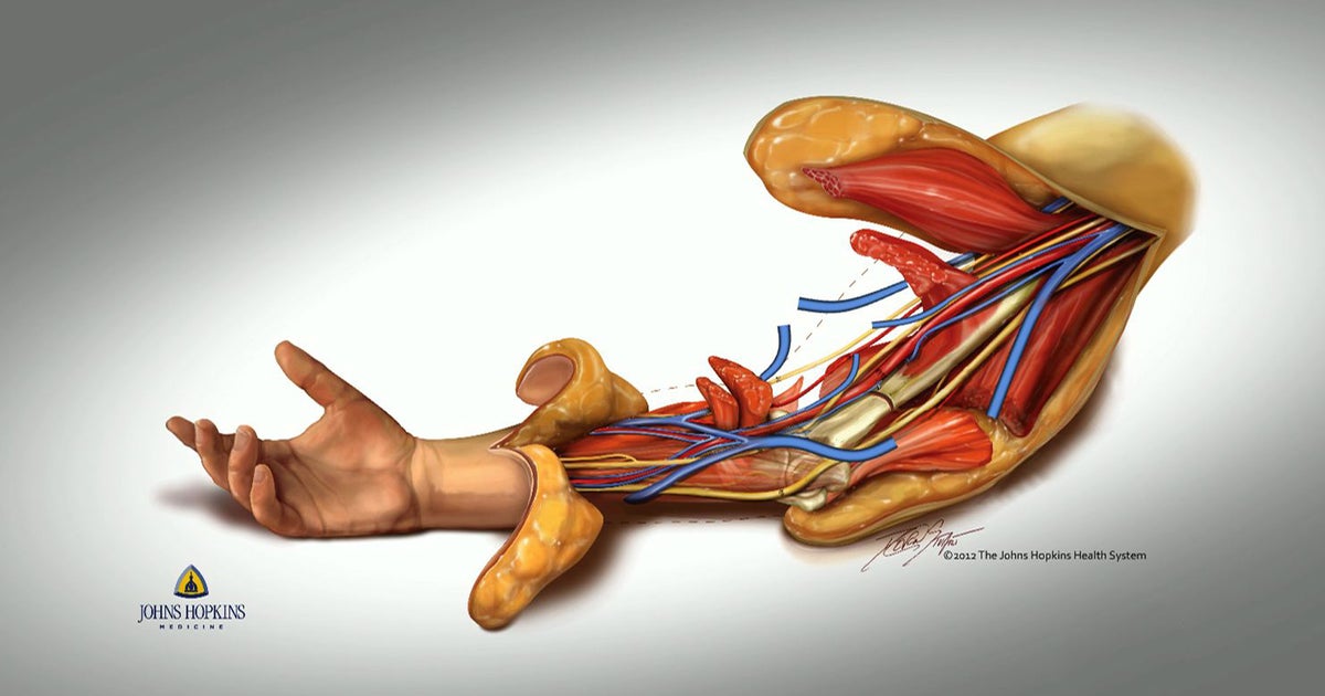 Hand transplant program for kids launched at Boston hospital - CBS News