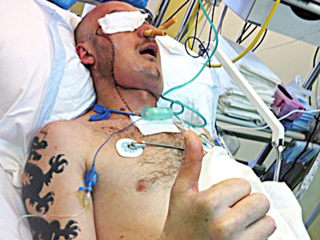 Amazing face transplants (GRAPHIC IMAGES)