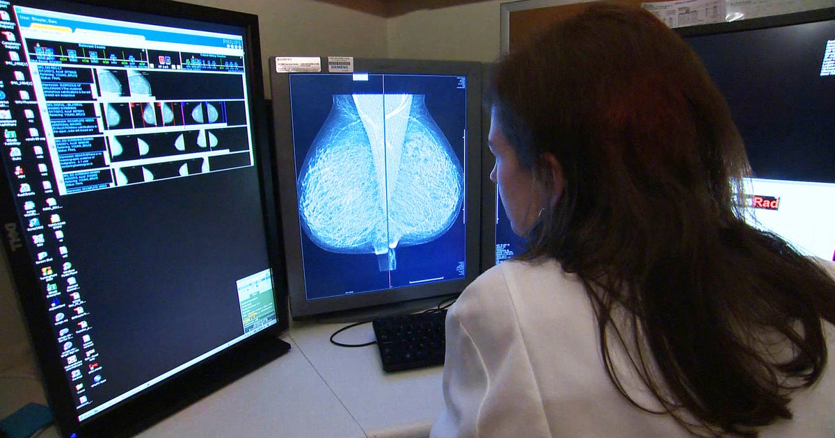 Study: More women opting for preventive double mastectomy - CBS News