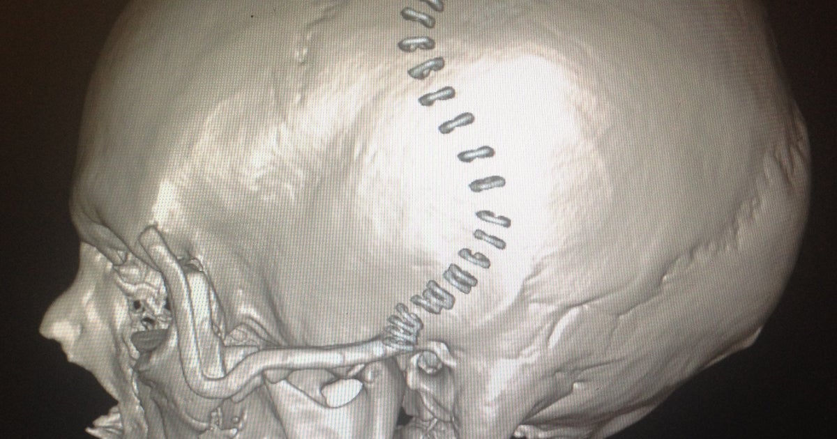 Man's face reconstructed with 3D printer after motorcycle accident ...