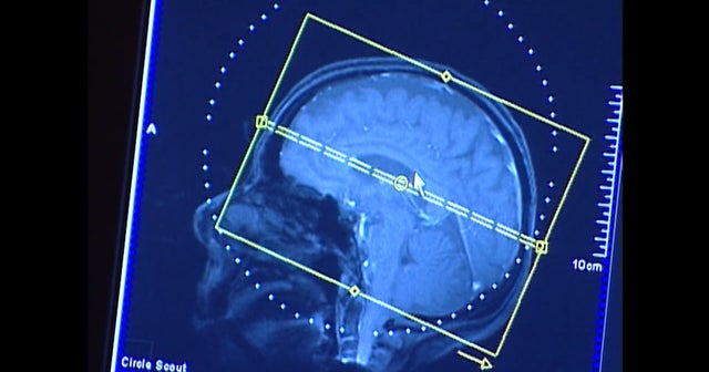 Too many unneeded brain scans for headaches, study suggests - CBS News
