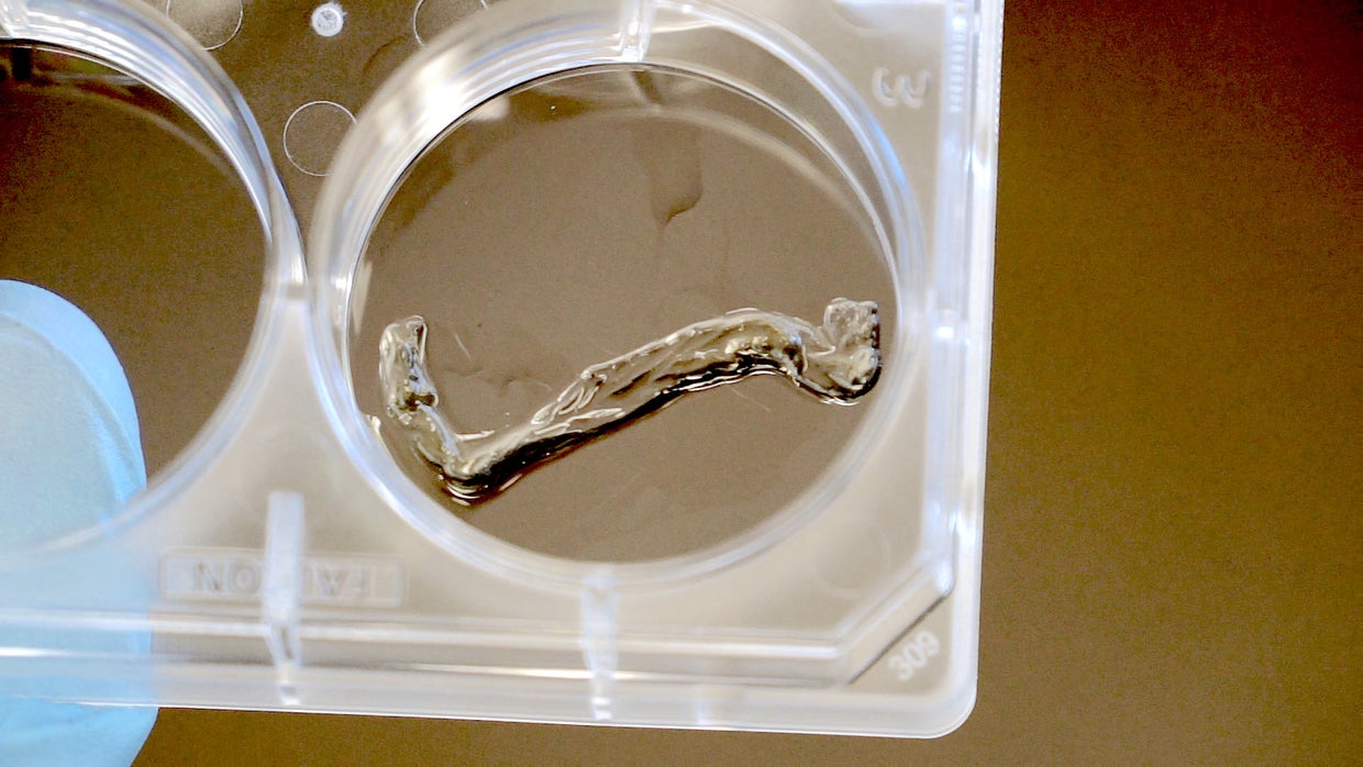 Photos: 3D printing and the future of burn treatment