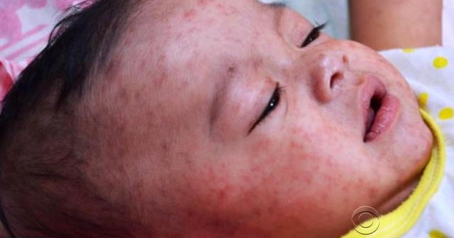 More cases of measles linked to Disney theme parks - CBS News