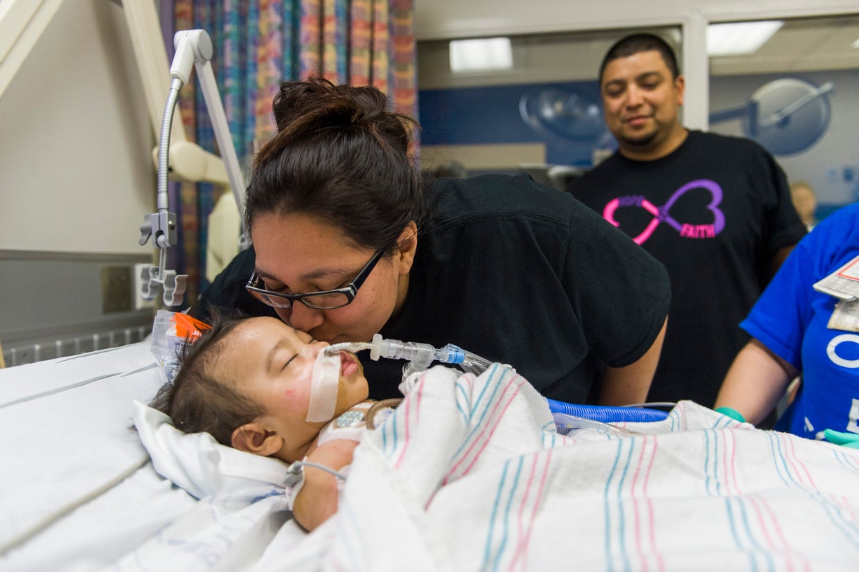 Conjoined twins Knatalye and Adeline Mata separated in Texas