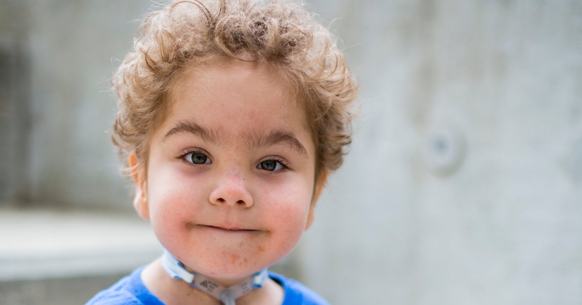 Meet 3 kids alive today thanks to a 3D printer - CBS News