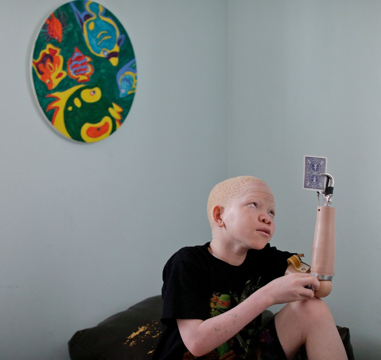 New limbs, new hope for Africa's hunted albino children