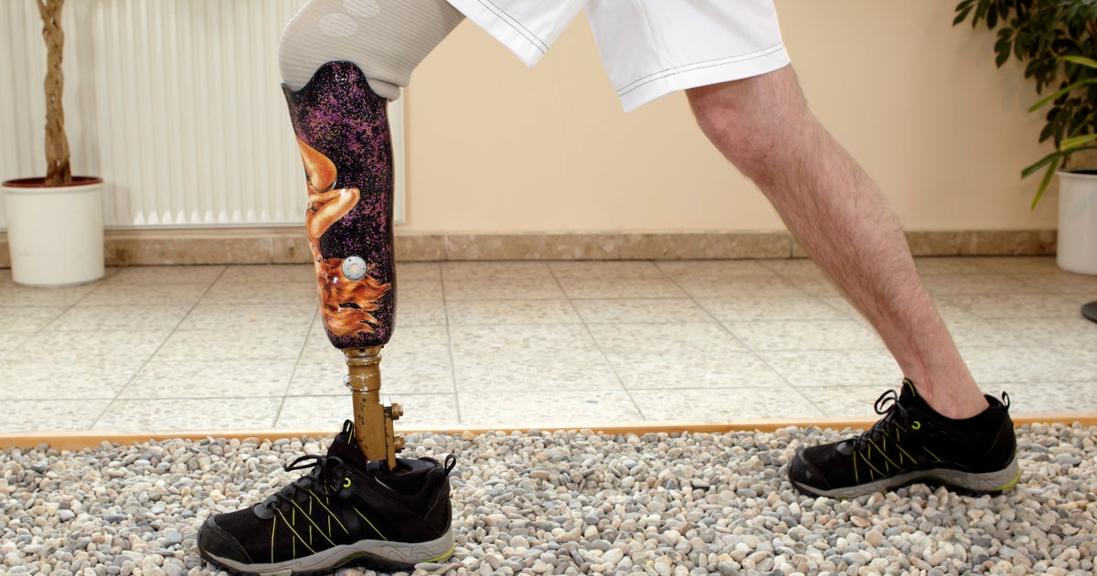 New technique may ease "phantom limb" pain in amputees - CBS News