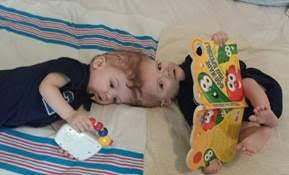 Formerly conjoined twins Jadon and Anias McDonald begin rehab - CBS News