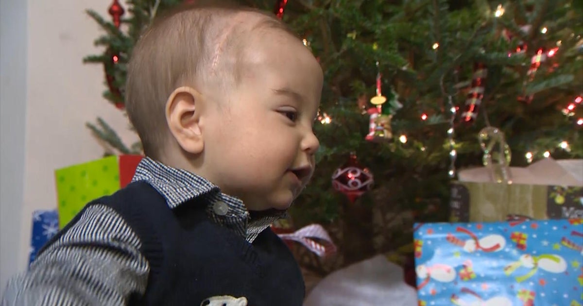 Innovative skull surgery helps baby celebrate first Christmas - CBS News