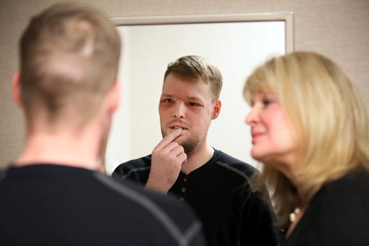 Face transplant at Mayo Clinic gives Andy Sandness new hope after ...