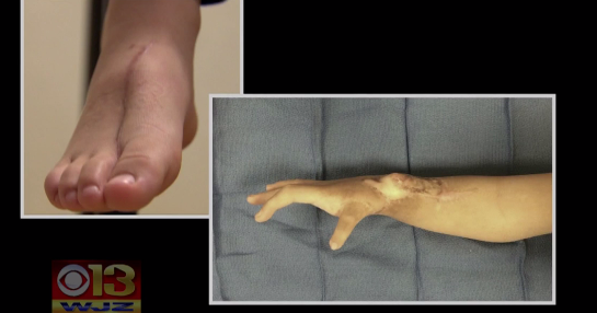 Baltimore surgeon gives boy new hand using his foot bones - CBS News