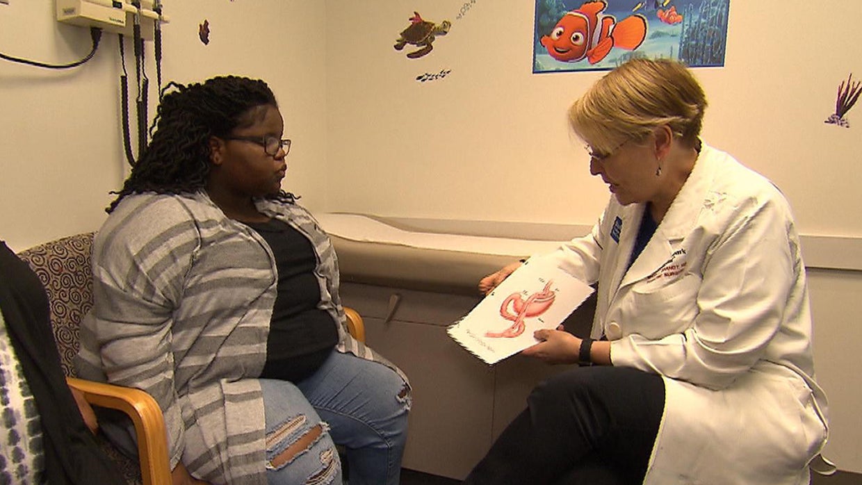 Woman's rare genetic disorder could hold the key to weight loss - CBS News