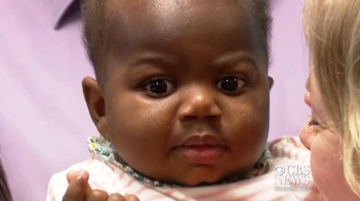 Baby born with extra legs undergoes successful surgery in Illinois ...
