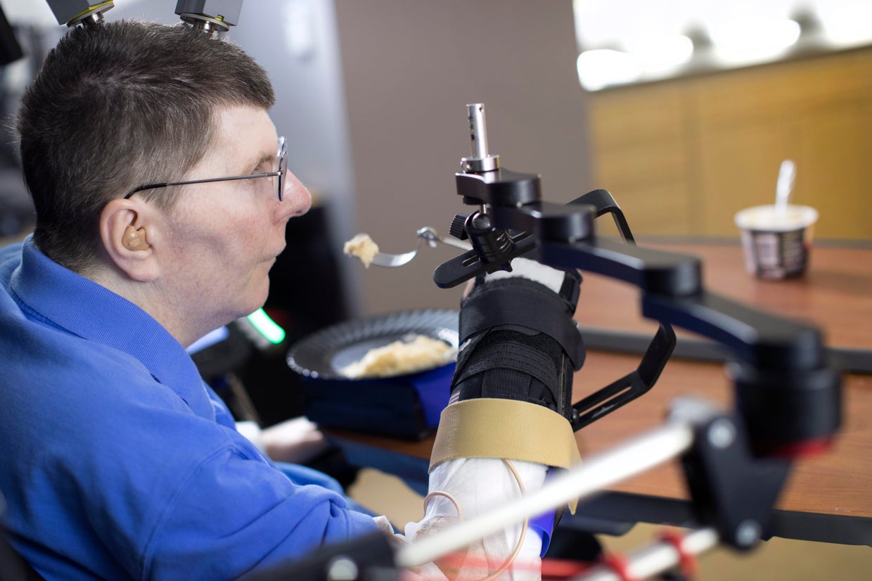 “Groundbreaking” technology restores movement in paralyzed man - CBS News
