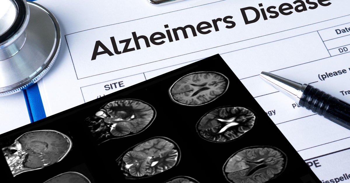 Alzheimer's deaths are skyrocketing, CDC reports - CBS News