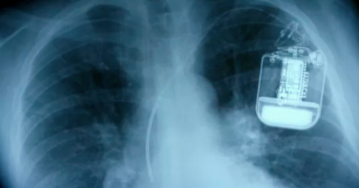 Judge rules that pacemaker data can be used against defendant - CBS News