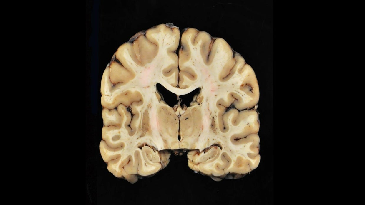 Combat veterans coming home with CTE - CBS News