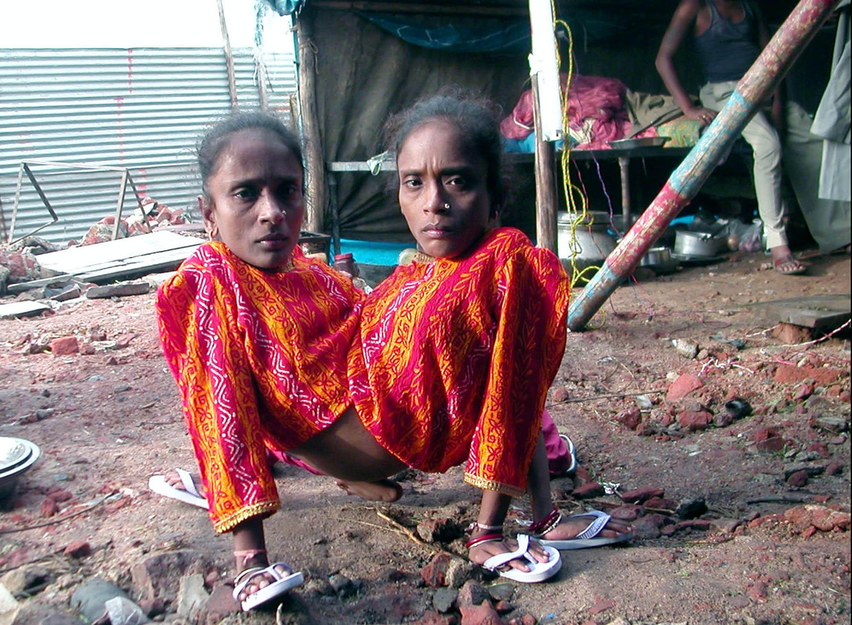 Conjoined twins (WARNING: GRAPHIC IMAGES)