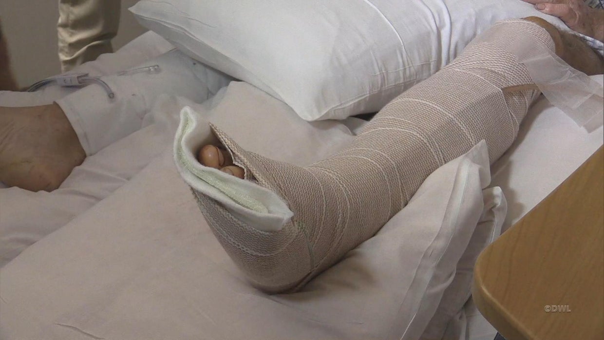 Man says lava bomb from Hawaii volcano "snapped" his leg in half - CBS News