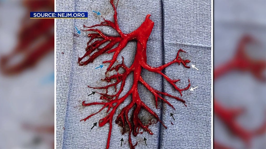 UCSF Patient Coughs Up Huge Blood Clot Shaped Like Lung - CBS San Francisco