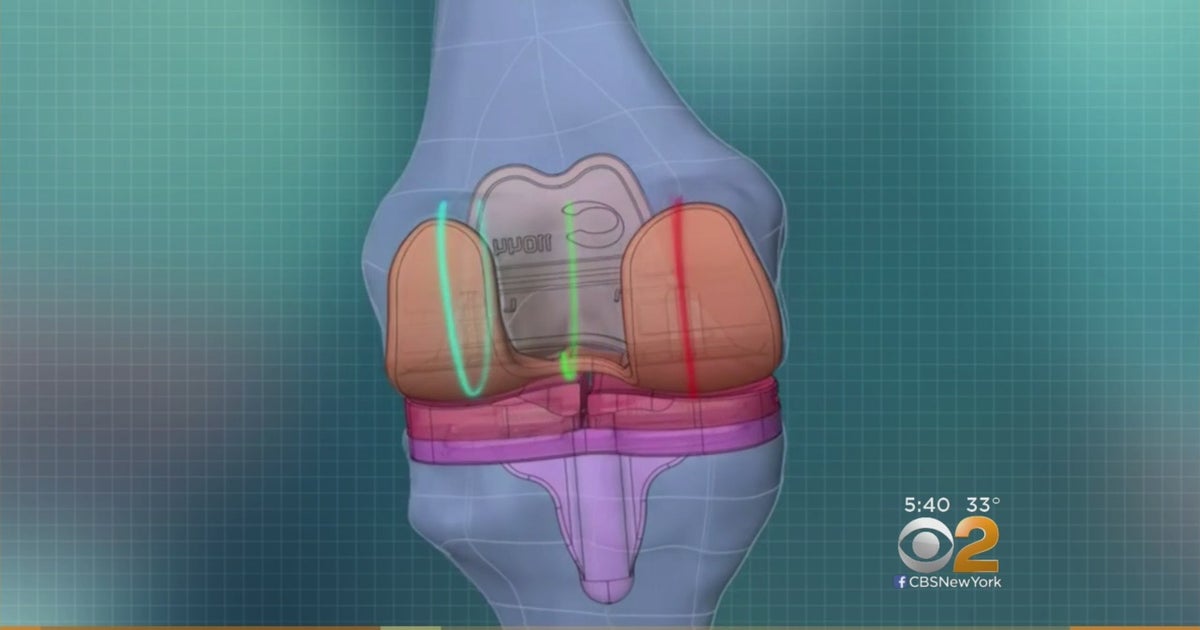 3D Printed Knees May Make Replacement Surgeries Easier And Last Longer ...