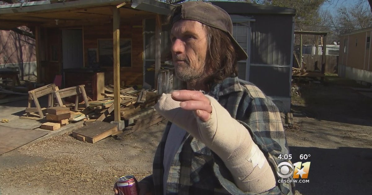 Man Almost Loses Fingers After Dog Attacked Him In Wilmer - CBS Texas