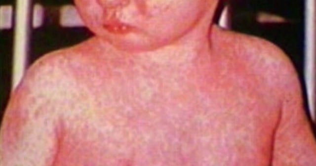 "Alarming" surge in measles cases in 98 countries, UNICEF says - CBS News