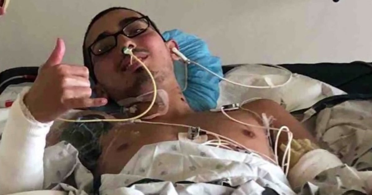 Army Recruits Leg Amputated After Contracting A Flesh Eating Disease