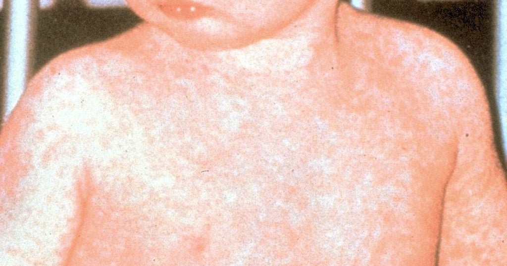 U.S. Measles Cases Hit Highest Mark In 25 Years - CBS San Francisco