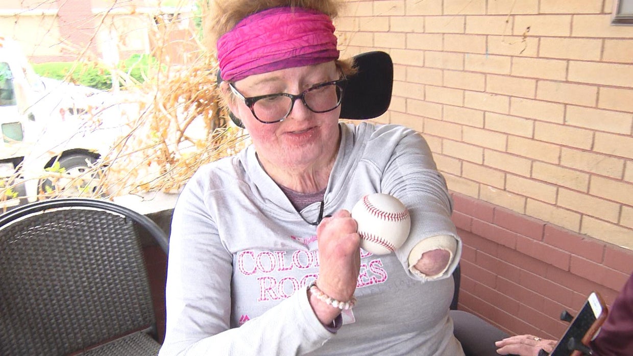 Burn Victim Left With One Arm Will Throw Out A Rockies First Pitch ...