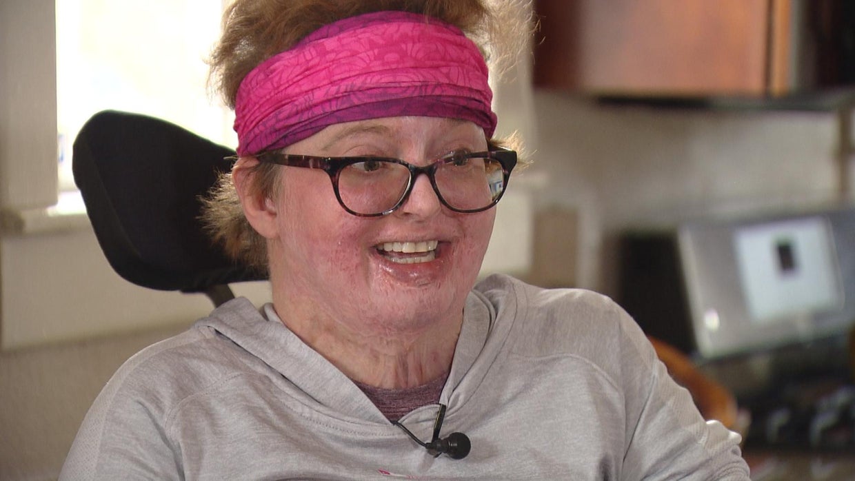 Burn Victim Left With One Arm Will Throw Out A Rockies First Pitch ...