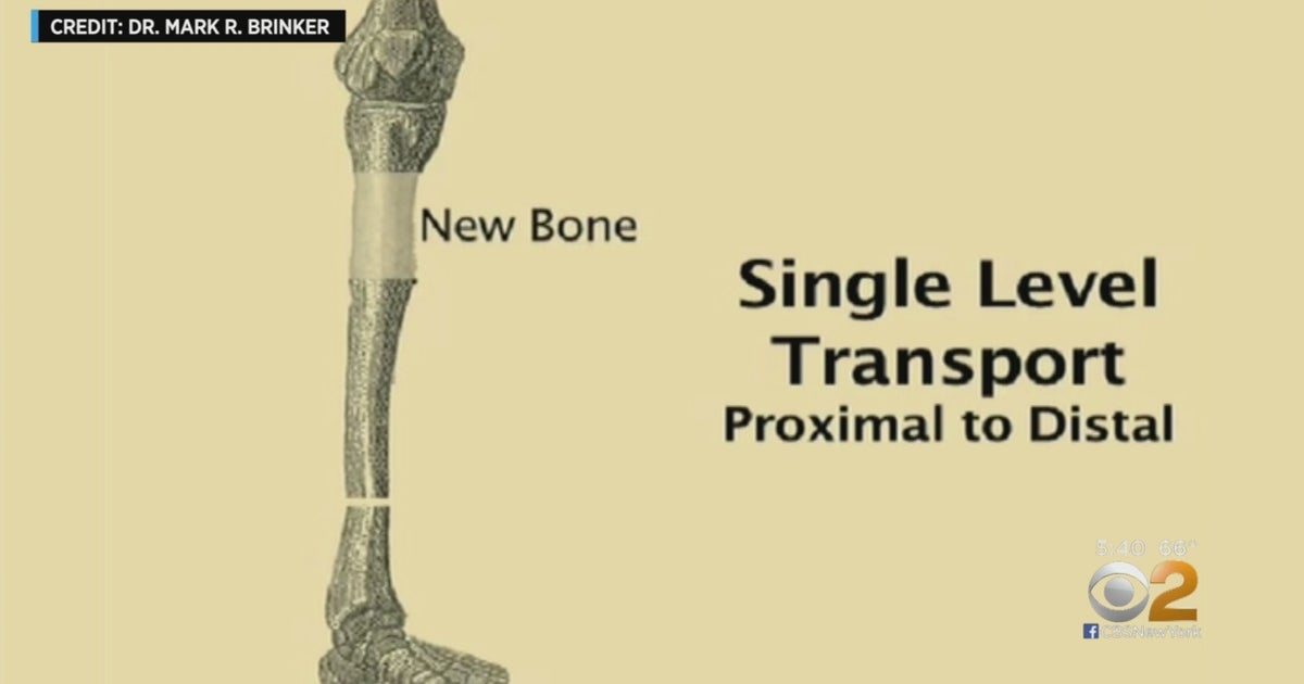 Amazing Procedure By Sloan Kettering Doctor Saves Leg Of Young Boy With ...
