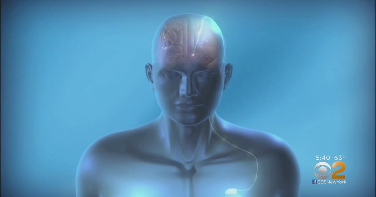 New Device Implanted Into The Brain May Help Epilepsy Patients Avoid ...