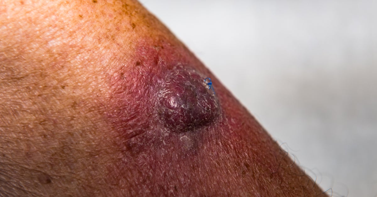 Basking In The Texas Sun? Prolonged Exposure Increases Chance Of Skin ...