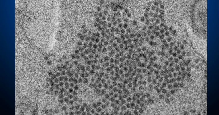 UCSF Researchers Find 'Circumstantial Evidence' Linking Virus To ...