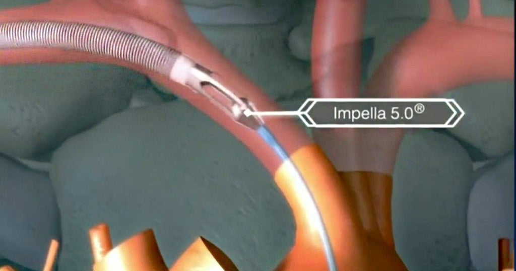 American Heart Month: High-Tech Pumps To The Rescue - CBS New York