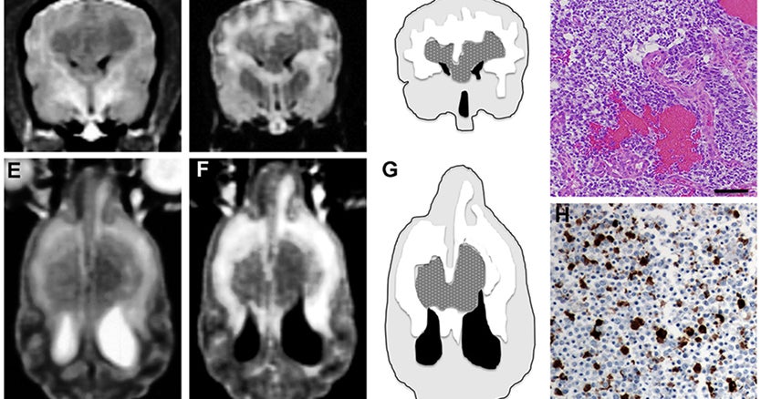 What Is Glioblastoma? How Scientists Are Working To Cure This ...