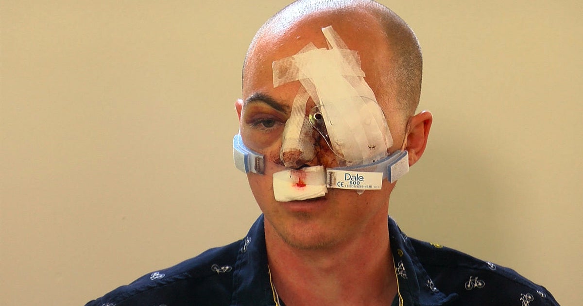 Man Who Lost Eye In May 31 Protest Sues City Of Mpls. For More Than ...