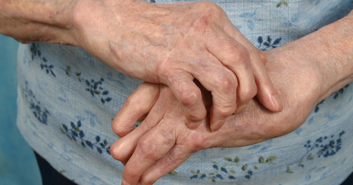 Newly-discovered cell could signal when rheumatoid arthritis patients ...