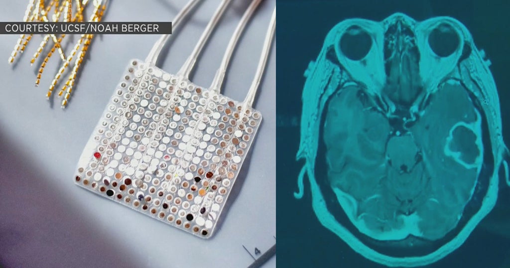 UCSF Developing Device That Allows Human Brains to Control Machines ...