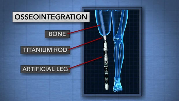 A giant step forward for users of artificial legs - CBS News