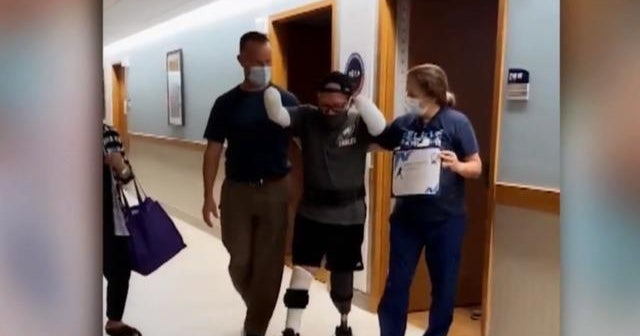 COVID-19 patient recovers after multiple amputations - CBS News