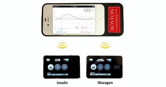 Diabetes breakthrough? Bionic pancreas monitors sugar, triggers doses ...