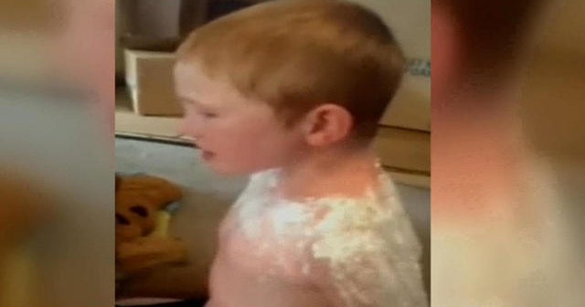 Daycare under investigation for boys' extreme sunburn - CBS News