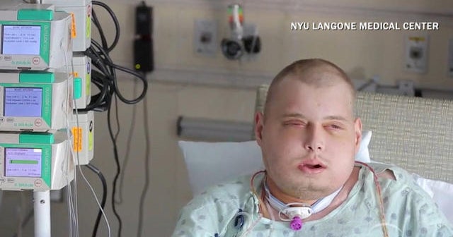 "Most extensive" full face transplant patient recovering - CBS News