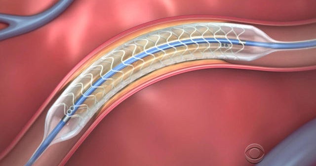 U.S. surgeons implant first dissolvable stent - CBS News