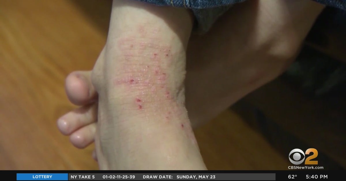 Study Finds Oral, Arthritis Drug RINVOQ Effective Against Moderate To ...