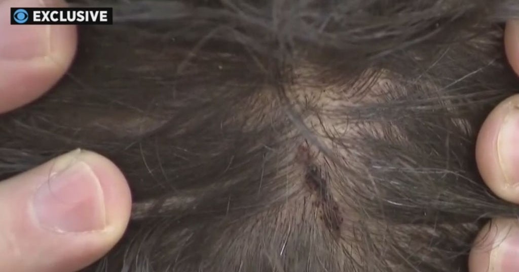 Exclusive: Man Speaks Out After Being Randomly Struck In Head With Rock ...