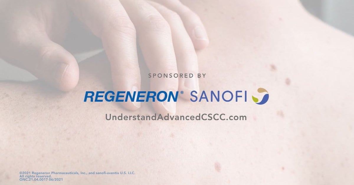 Understanding Two Types Of Advanced Non-melanoma Skin Cancer - CBS Los ...