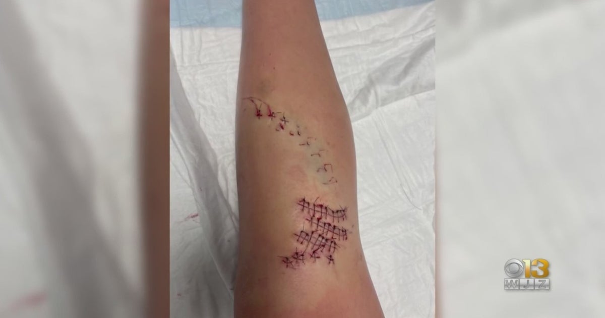 12-Year-Old Pennsylvania Girl's Injuries Consistent With Shark Bite, A ...